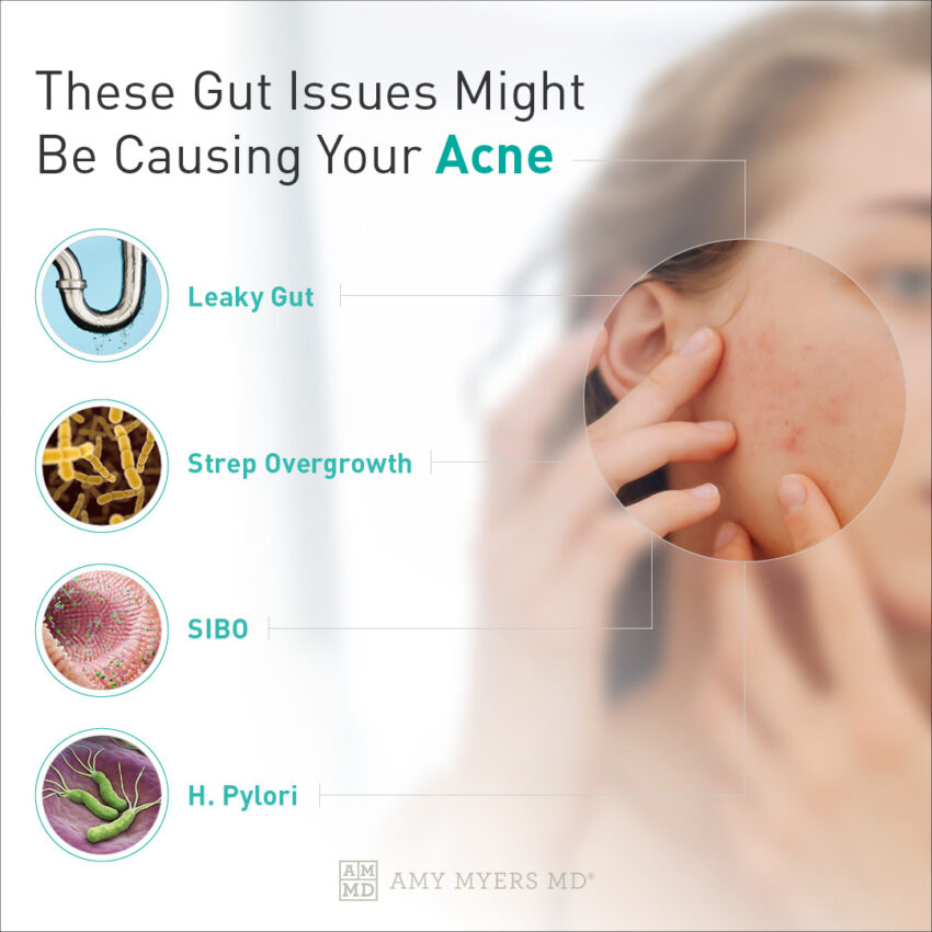 How Addressing Your Gut Can Help With Your Acne – Amy Myers MD