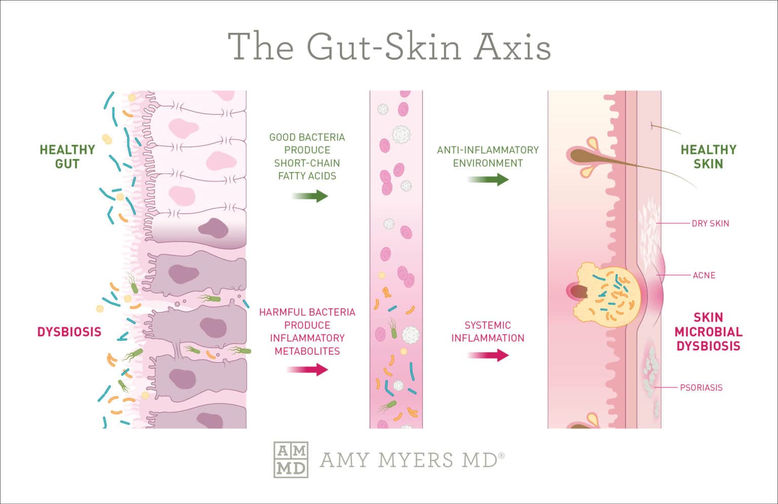 How Addressing Your Gut Can Help With Your Acne – Amy Myers MD